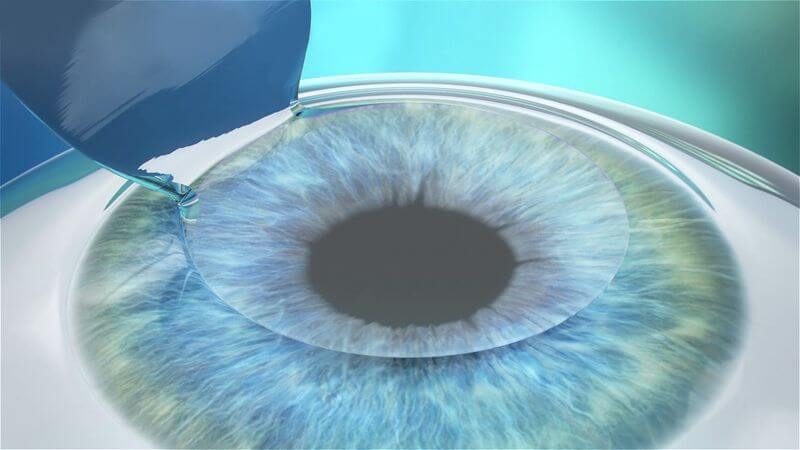 LASIK Eye Surgery Albuquerque | LASIK Albuquerque | Juliette Eye