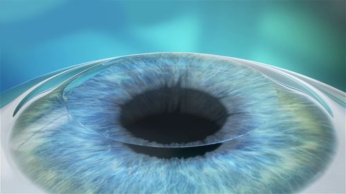 LASIK Eye Surgery Albuquerque | LASIK Albuquerque | Juliette Eye